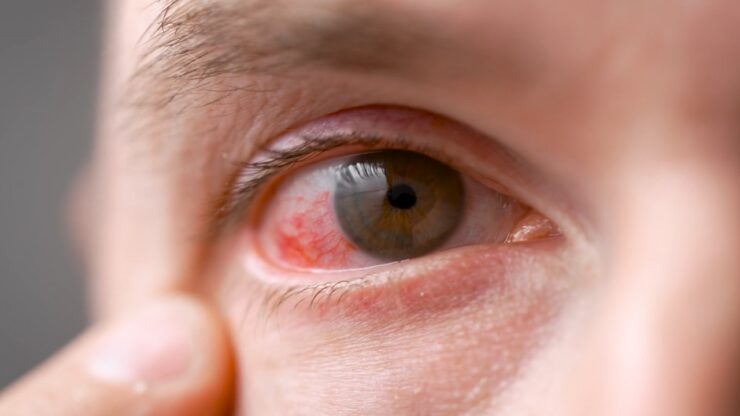 COVID Eyes: Seeing Through the Haze - Symptoms, Treatment, and More